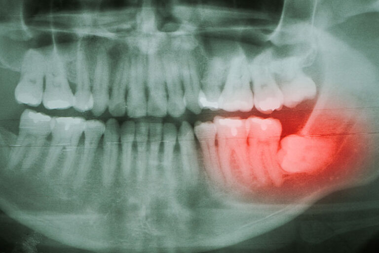 Wisdom Teeth Extractions | Post Falls, ID | River City Dentistry
